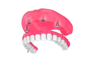 Realize Sorrisos - Dentista Ceilândia | Implantes Dentários